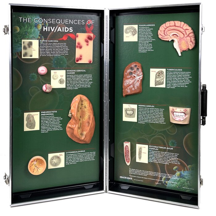 HIV / AIDS Health Consequences 3-D Display | Health Edco