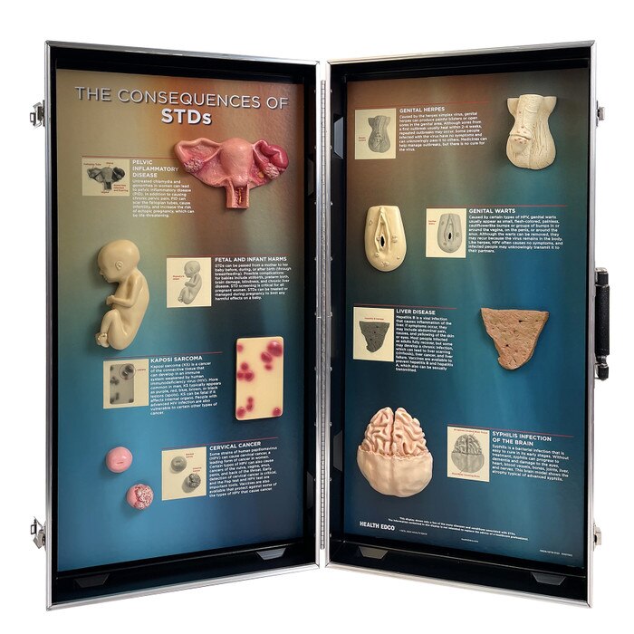 STDs & STIs Health Consequences 3-D Display | Health Edco